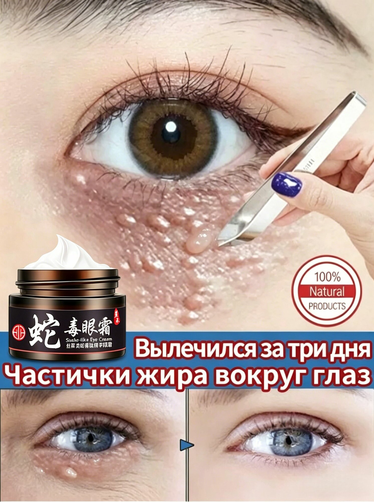 Средство от милиумов на лице, Крем для век антивозрастной, для зоны вокруг глаз, от темных кругов и морщин, отёков вокруг глаз, с эффектом лифтинга 30 г для кожи вокруг глаз лифтинг крем