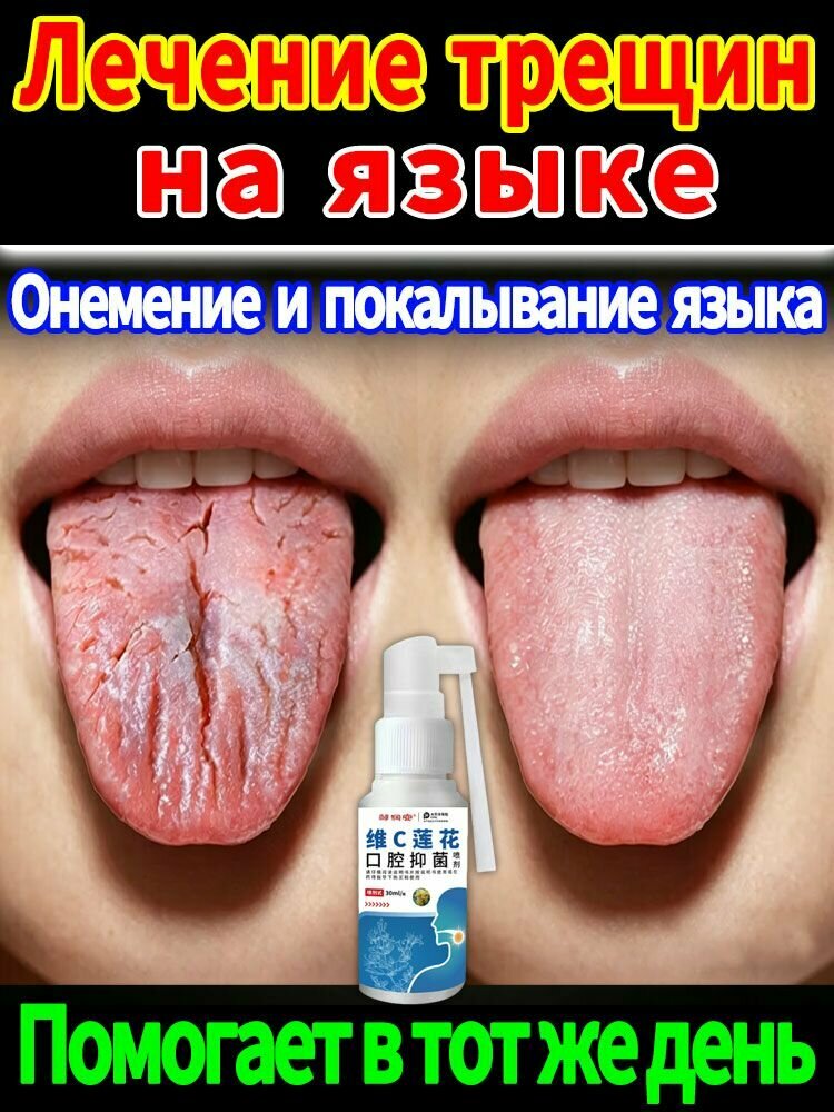 30 мл, Спрей для восстановления трещин на языке, Лечение глоссита, сухости во рту, освежающий дыхание, Снимают отек и боль в языке