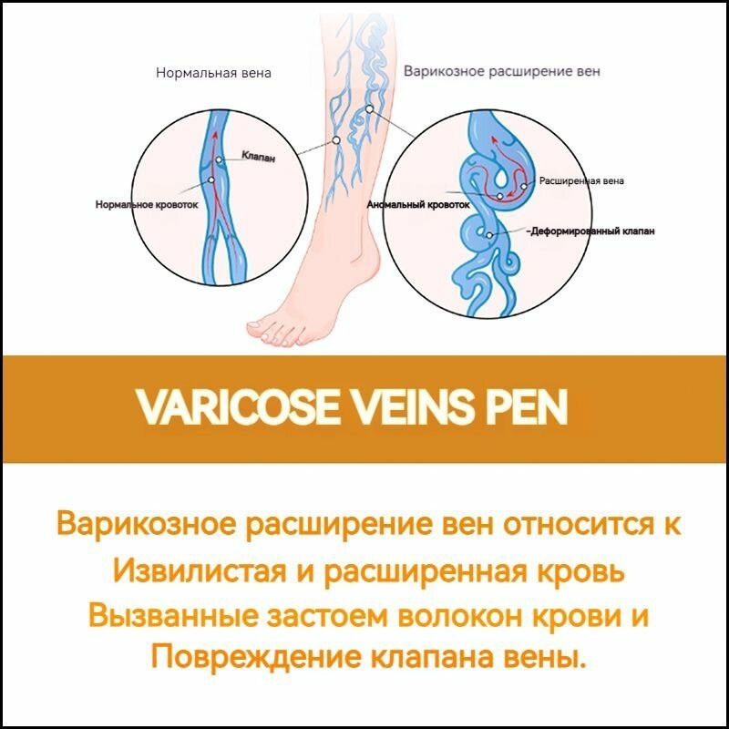 Ручка для лечения варикозного расширения вен, использовать для лечение сосудов, отеков и тяжести в ногах, сосудистых звездочек, тромбоза