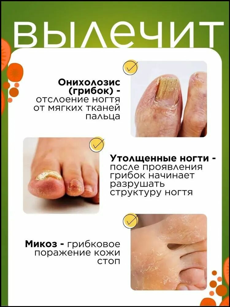 Мазь от грибка ногтей на ногах, мазь "Ноготок", "Ноготок" от грибка ногтей, Естественно и безболезненно крем 20 г.