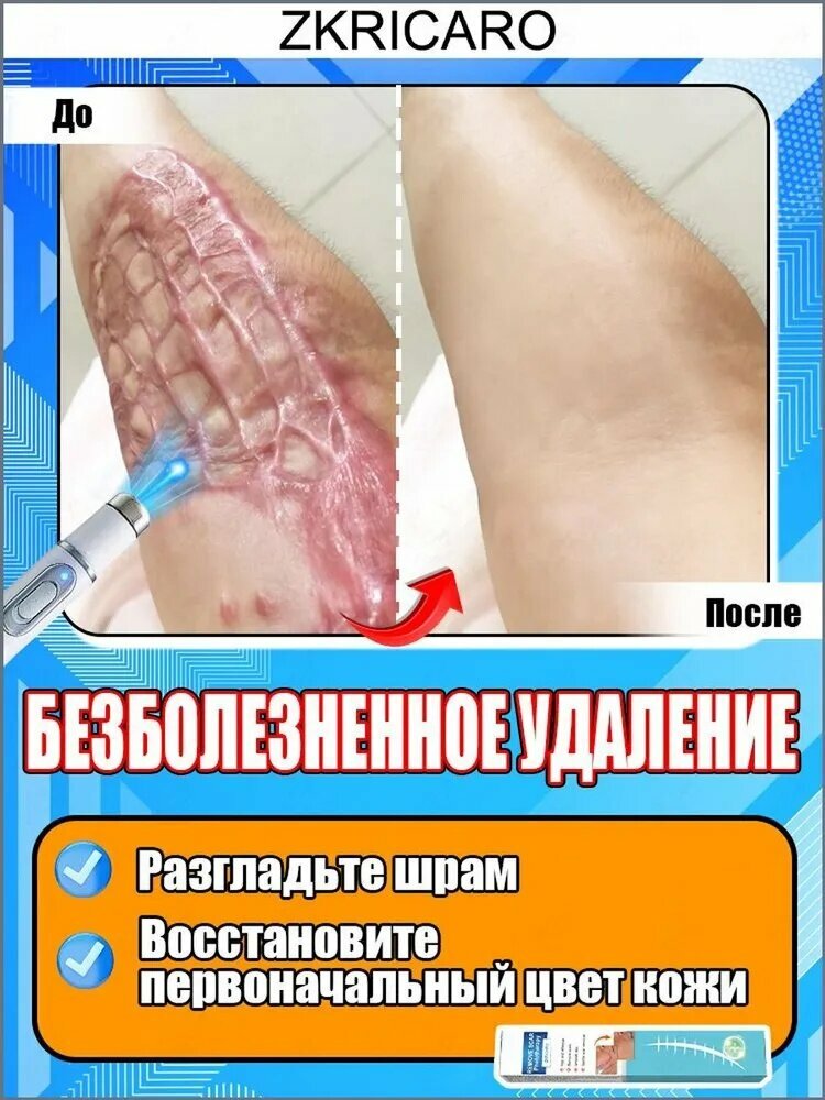 Лазерная ручка для удаления рубцов. Быстро удаляет рубцы, растяжки, ожоги, угри, гиперплазию и послеоперационные рубцы, подходит как для мужчин, так и для женщин. 2 штука
