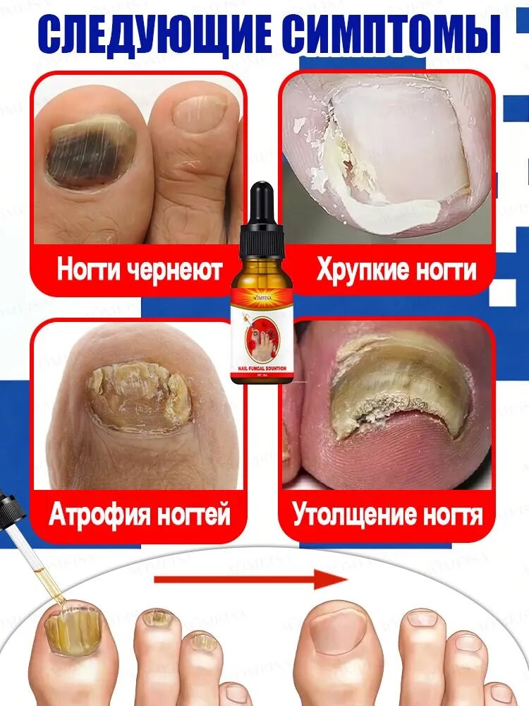 Противогрибковое масло для ногтей. Быстро устраняет грибковые инфекции на ногтях ног. Укрепляет ногти. 30 мл