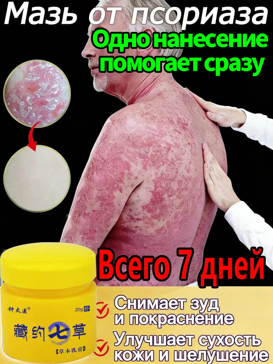Негормональная мазь от псориаза и лишая, экземы, дерматита, акне, 20г, китайская чудо мазь для лица рук тела