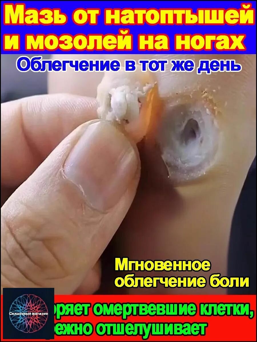 Эксклюзивный крем для устранения папиллом, натоптышей и бородавок, включая подошвенные и колломоидные образования, а также для удаления заноз
