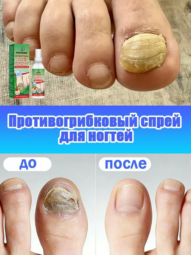 1 флакон 30 мл. Удаляет грибок ногтей на руках и ногах, подавляет рост грибка и способствует здоровому росту ногтей.