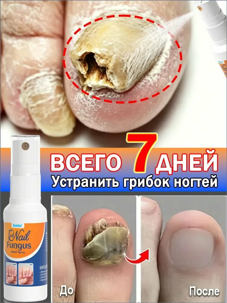 От грибка ногтей на ногах средство эффективное, спрей от грибка ногтей на ногах: лечение, укрепление и восстановление, 30 мл