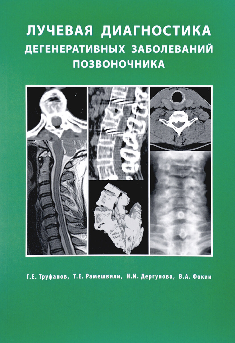 Лучевая диагностика. Дегенеративных заболеваний позвоночника