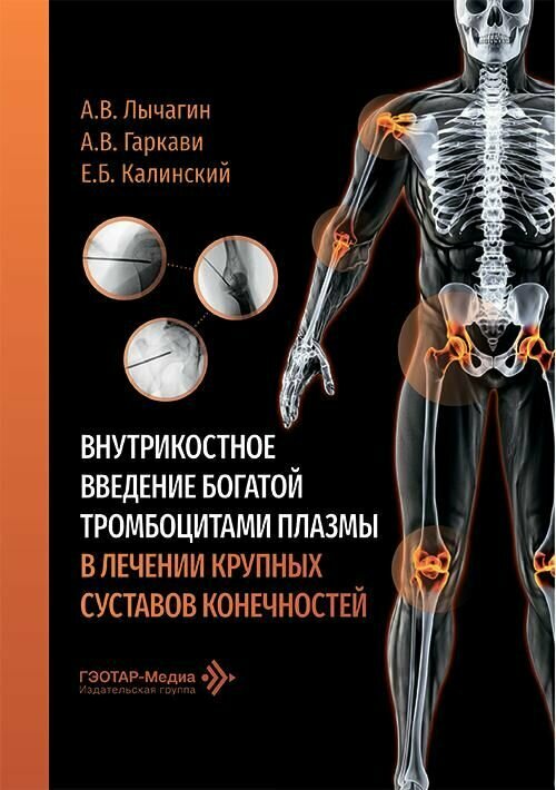 Внутрикостное введение богатой тромбоцитами плазмы в лечении крупных суставов конечностей / А. В. Лы