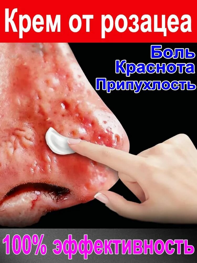 Мазь от розацеа на лице купероза и покраснений, Средство от розацеа, Китайская чудо-мазь для лечения розацеа,20 г