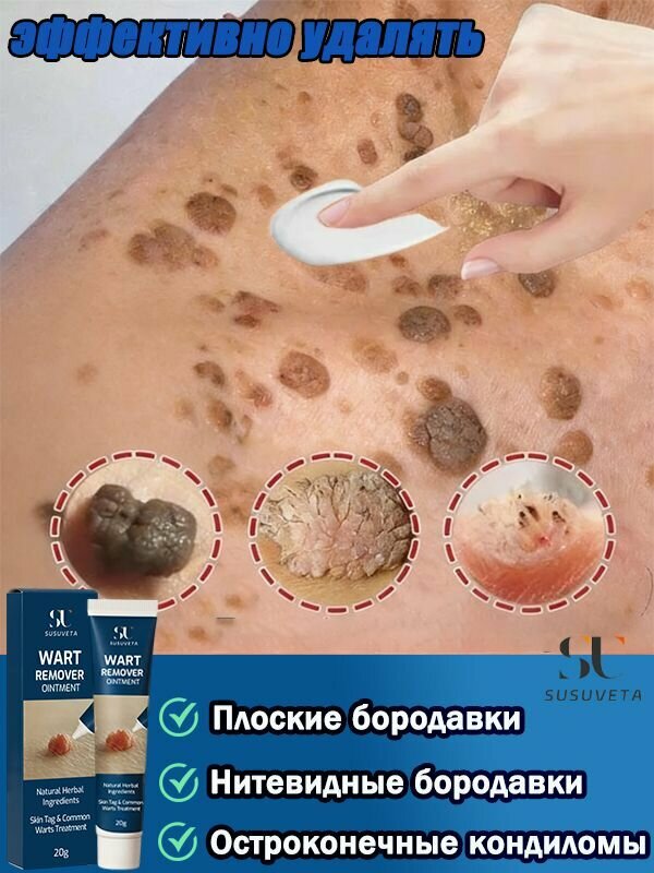 Крем для удаления бородавок, папиллом и родинок, подходит для использования на теле, руках и шее. Безболезненный и не оставляющий шрамов. 20 г.