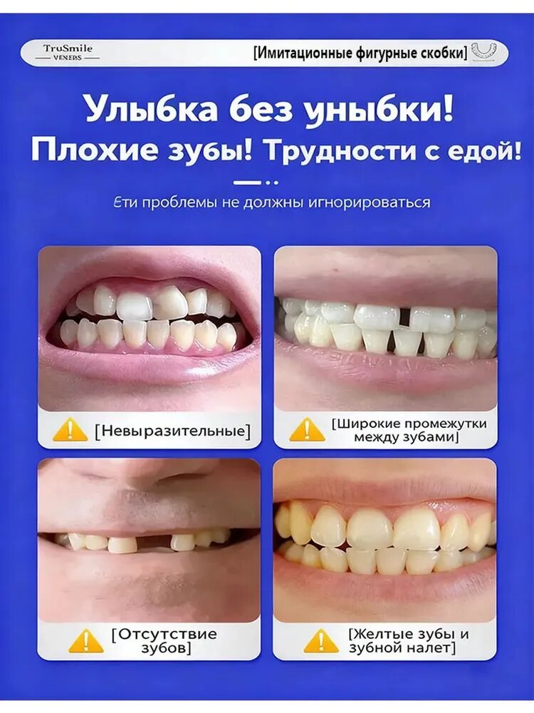 Декоративная временная пломба для зуба. Виниры для зубов накладные верхние и нижние силиконовые. Виниры. Брекеты. Материал пломбировочный временный