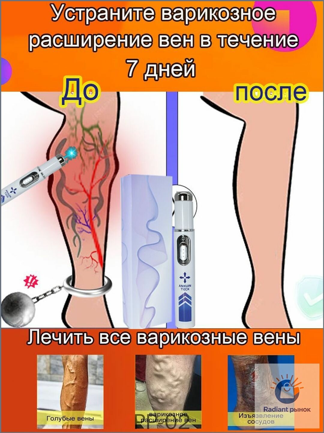 Лазерное лечение варикозного расширения вен. эффективное и быстрое удаление, безболезненное, без шрамов, без побочных эффектов