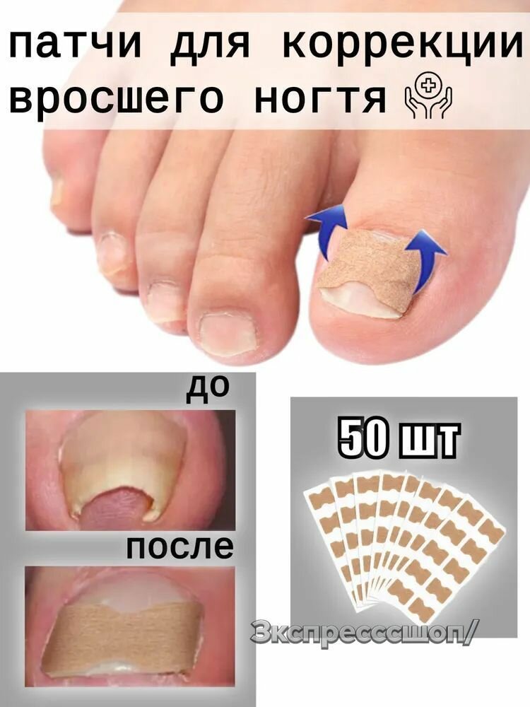 Пластыри для коррекции вросших ногтей на пальцах ног, 50 штук