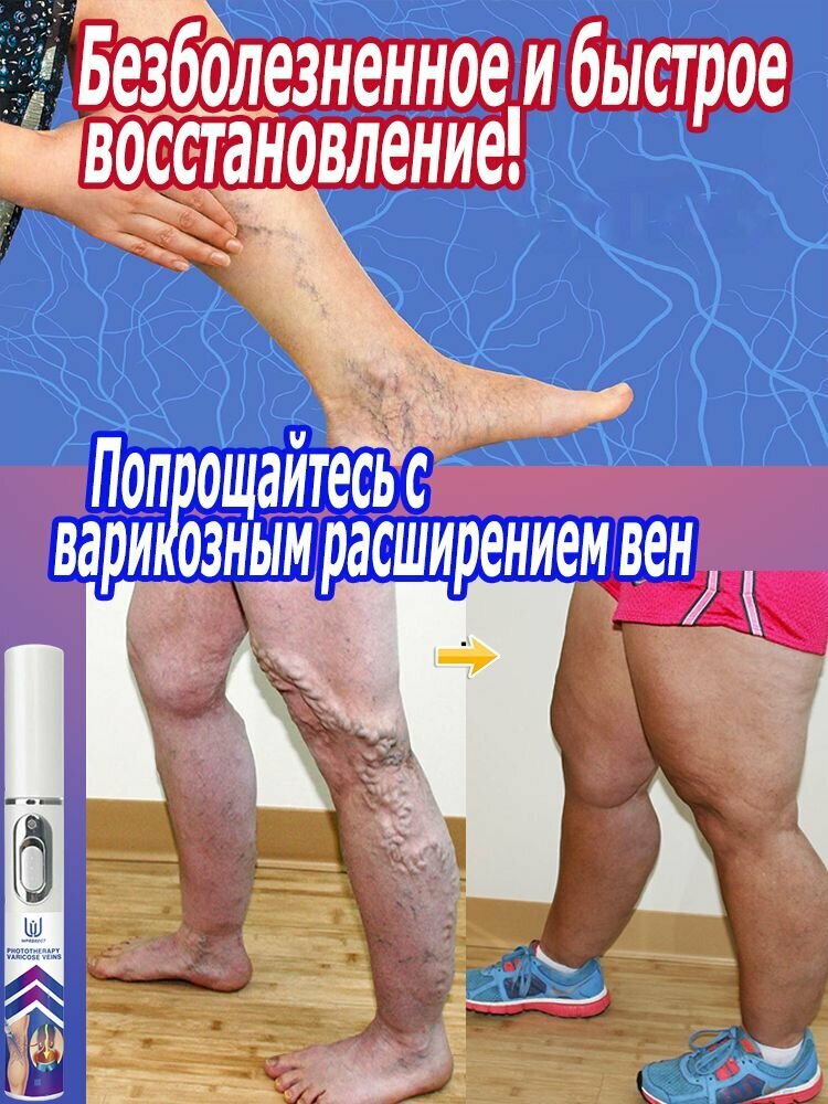 Лазерное оборудование используется для устранения варикозного расширения вен, кровеносных сосудов, образования тромбов, усталости ног и отеков, а также безболезненно и без побочных эффектов