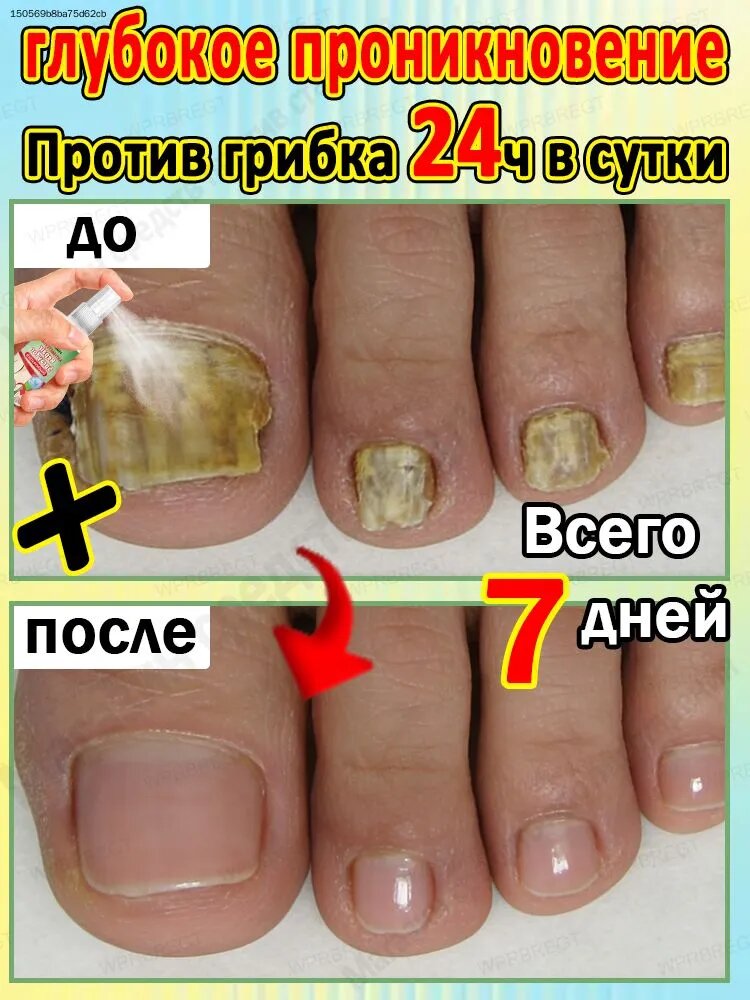 Спрей для удаления онихомикоза, уничтожает грибки за 24 часа, эффективно лечит грибковые инфекции ногтей на ногах и ногтях на руках, укрепляет и восстанавливает ногти, 30 мл.
