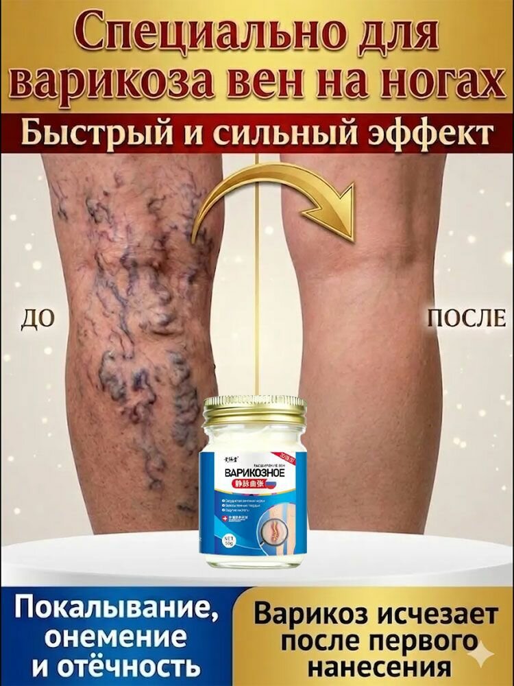 Чудо мазь от Варикоза и усталости, Мазь от варикоза вен на ногах, Крем Венотоник от отеков и тяжести в ногах, от венозных сеточек при тромбофлебите