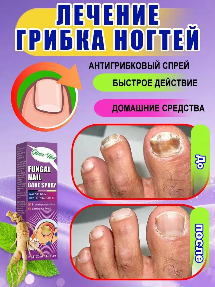 Спрей от грибка ногтей на ногах и онихомикоза. Эффективное устранение инфекции, утолщения и желтизны, надежное укрепление пластины, 30 м