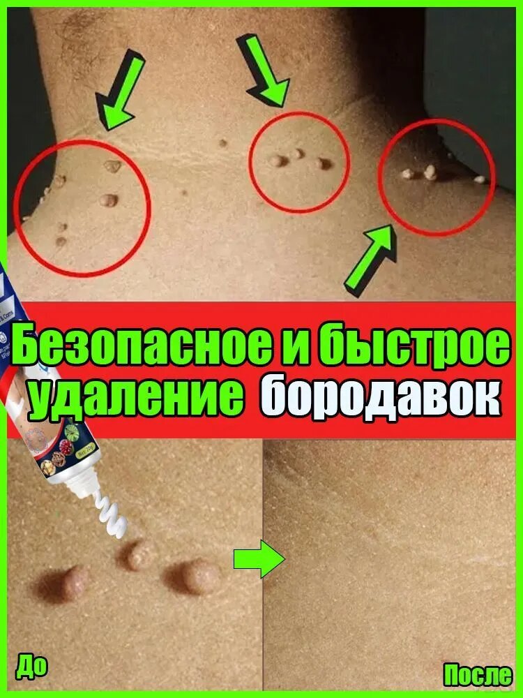 Мазь от бородавок, папиллом и мозолей 20 г, безболезненное удаление без следов, эффективное средство для домашнего ухода