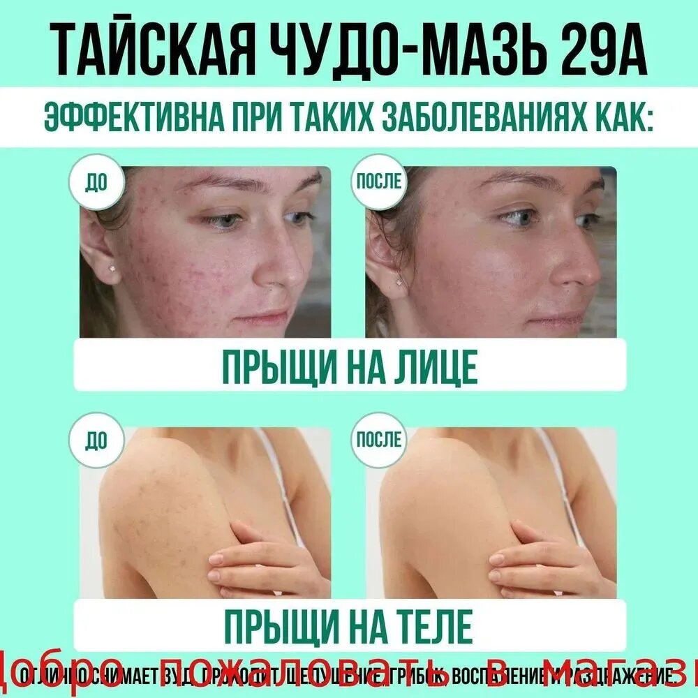 Тайская мазь 29А Король кожи от грибка ногтей и кожи, от дерматита и себореи, от прыщей, 3 шт — фото 1