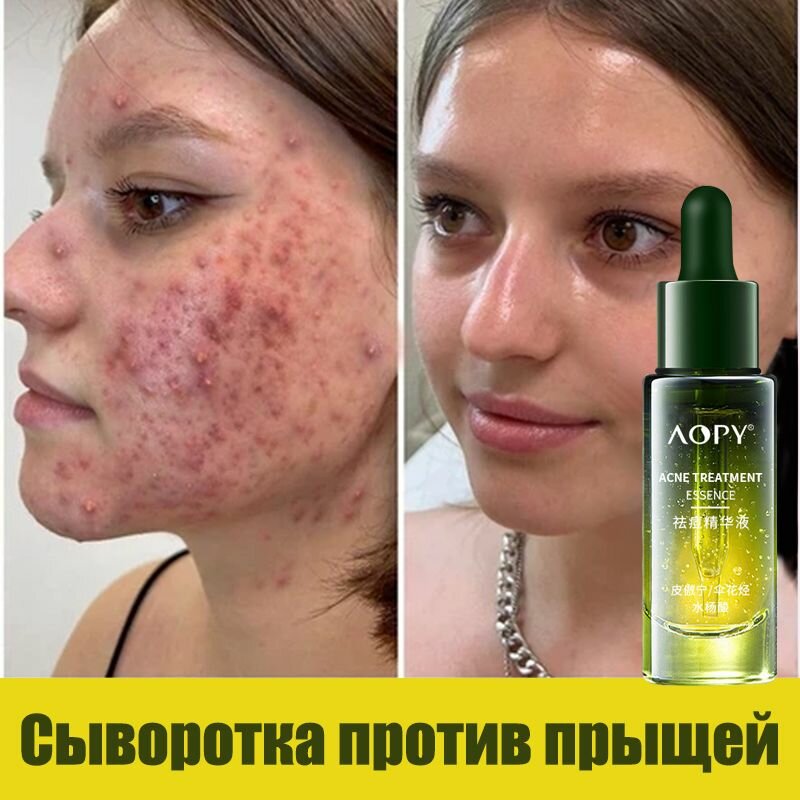 Восстанавливающая сыворотка для лица от прыщей, черных точек, угрей, акне, увлажняющая, для чувствительной кожи, с ниацинамидом и цинком, 30 мл