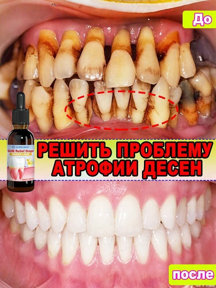 Против рецессии десен: восстанавливающие капли. Надежное укрепление, снятие отека и боли при пародонтите и гингивите, уход за ртом, 30 мл.