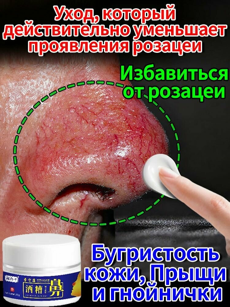 Крем от купероза и розацеа Фитол-9 Куперозан-Fito от покраснений и раздражений на коже, антикуперозный крем от розацеа