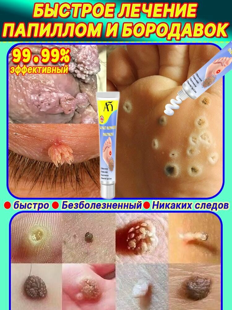 Гель-средство от папиллом, лечение бородавок, удаление родинок, крем от угревой сыпи, безболезненный, не оставляет следов, кожа становится гладкой и увлажненной, 5 шт