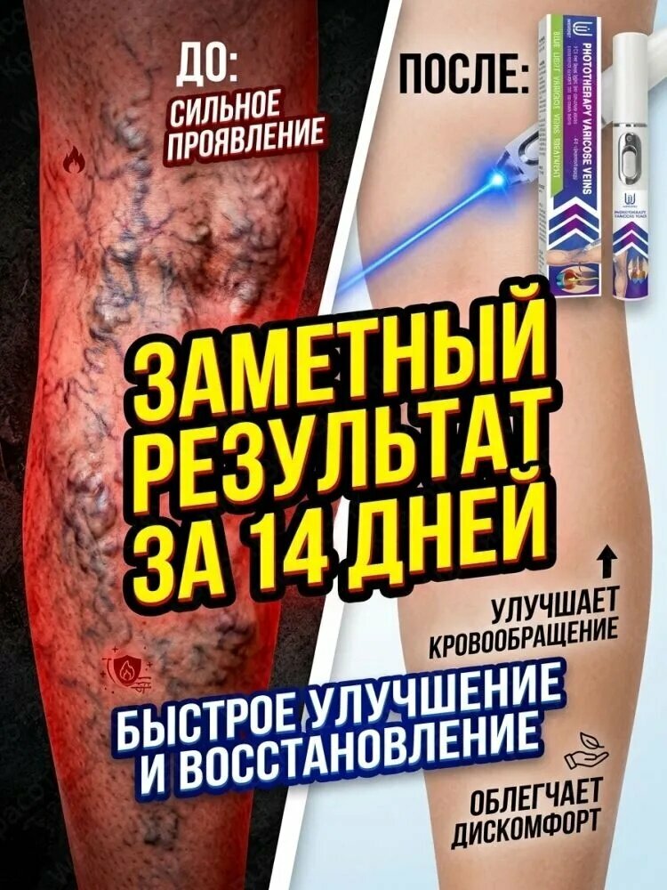 Варикозное расширение вен, лазерная указка, Эффективен при лечении варикозного расширения вен, сосудистых звездочек, тромбоза, усталости и опухших ног. 1 шт.
