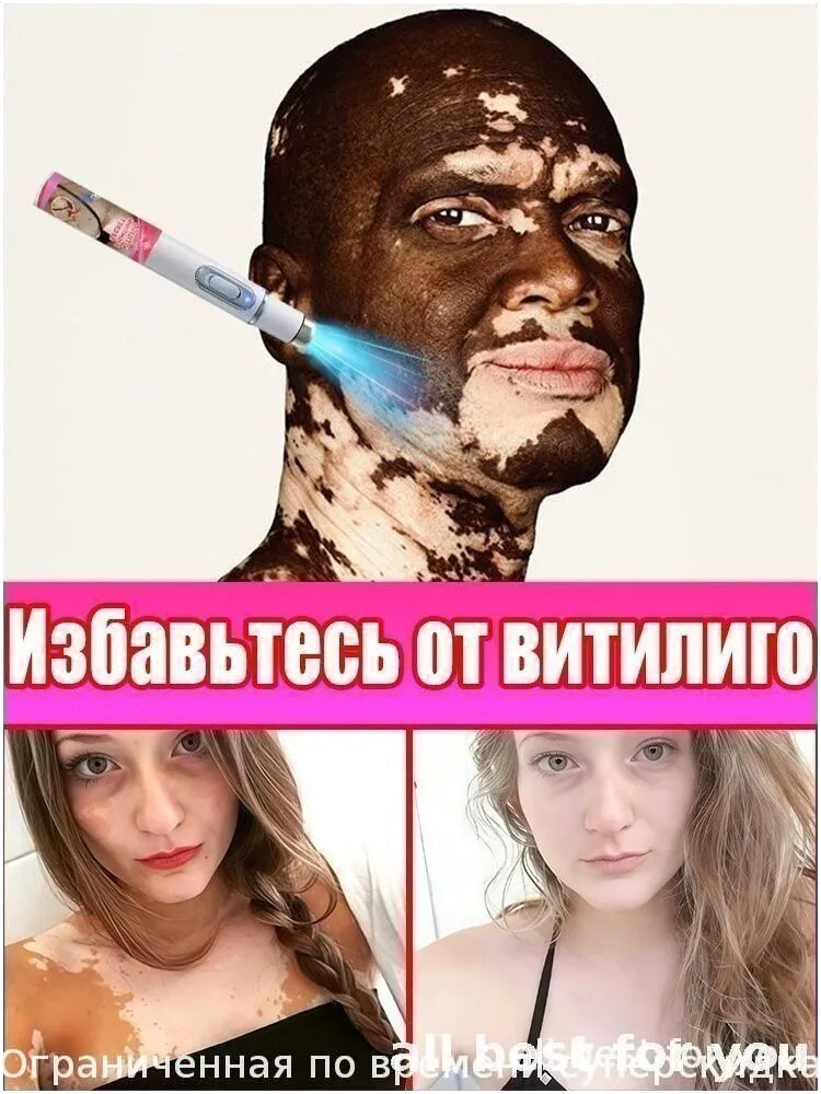 Качественный лазерный аппарат для результативной терапии витилиго обеспечивает безопасное и эффективное восстановление пигментации кожи, популярный выбор