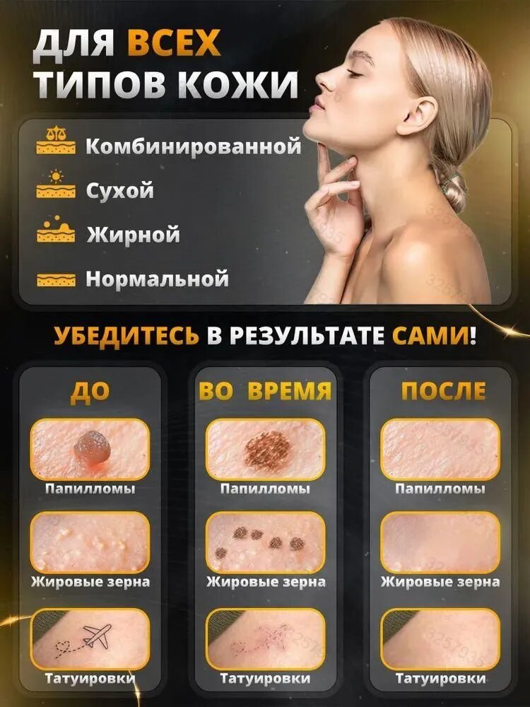 Косметологический комбайн D30+ для удаления папиллом и бородавок на лице и коже с 10 иглами — фото 1