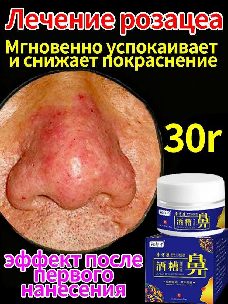 Мазь от Китайский розацеа на лице купероза и покраснений