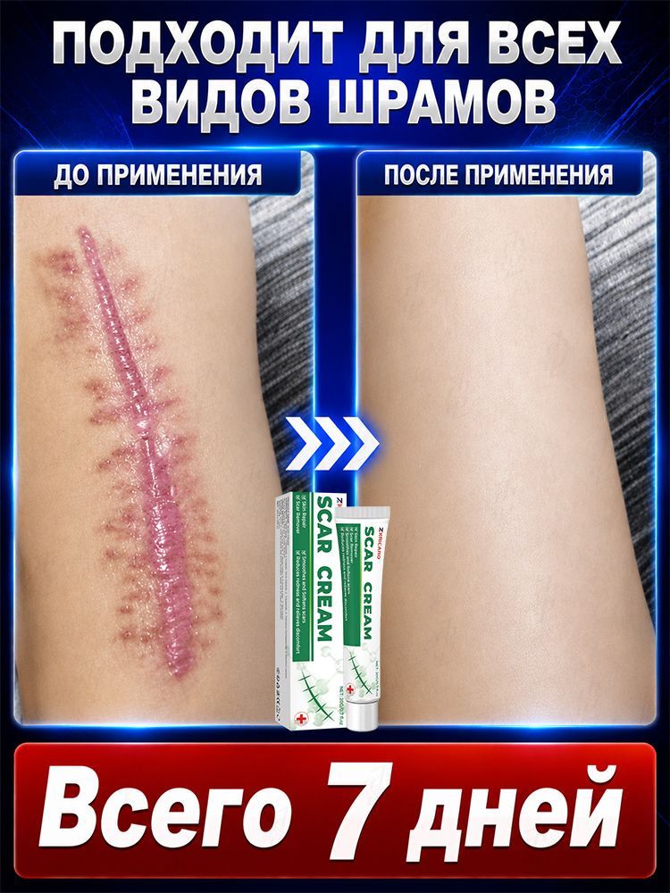 Крем для удаления шрамов. Быстро устраняет шрамы, растяжки, гипертрофические рубцы, послеоперационные рубцы, осветляет пигментацию. Подходит для лица и тела. 20 г.