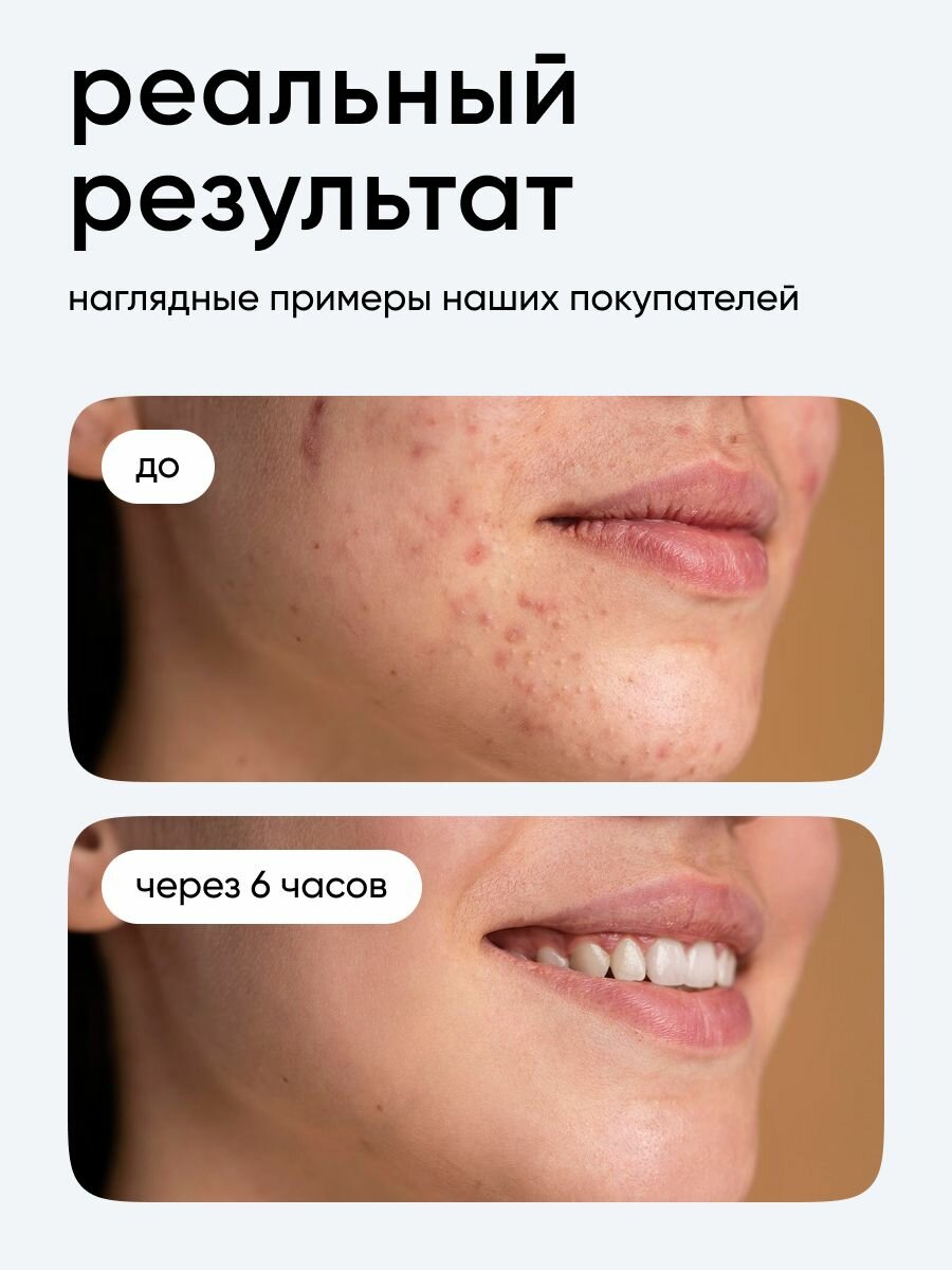 Clariskin Патчи от прыщей для лица гидроколлоидные, 10 шт.