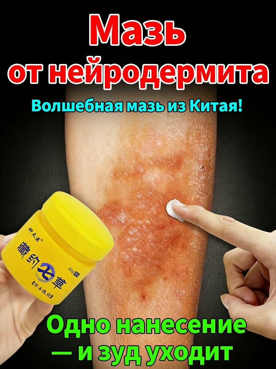 Мазь от нейродермита, экземы, дерматита, лишая быстрое снятие зуда и восстановление кожи. Лучшее средство для лечения акне и кожных высыпаний.