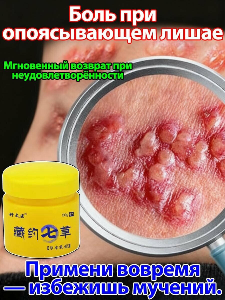 Мазь от опоясывающего лишая