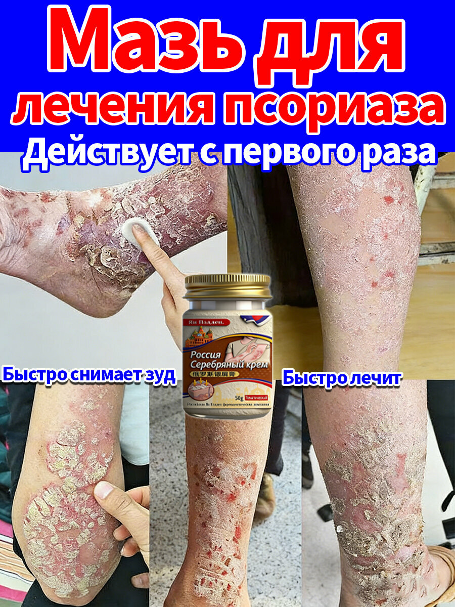 Крем от псориаза, быстрое облегчение зуда, при экземе, нейродермите, грибковых инфекциях, дерматите и себорее, эффективный уход за кожей, 50 г