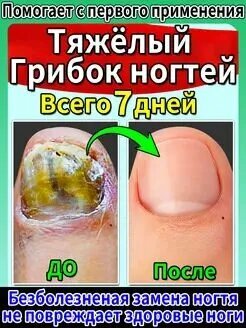 Противогрибковая мазь Ноготок от грибка ногтей на ногах и гиперкератоза, противогрибковое средство для ног, укрепляйте и восстанавливайте ногти, крем для лечения 20g