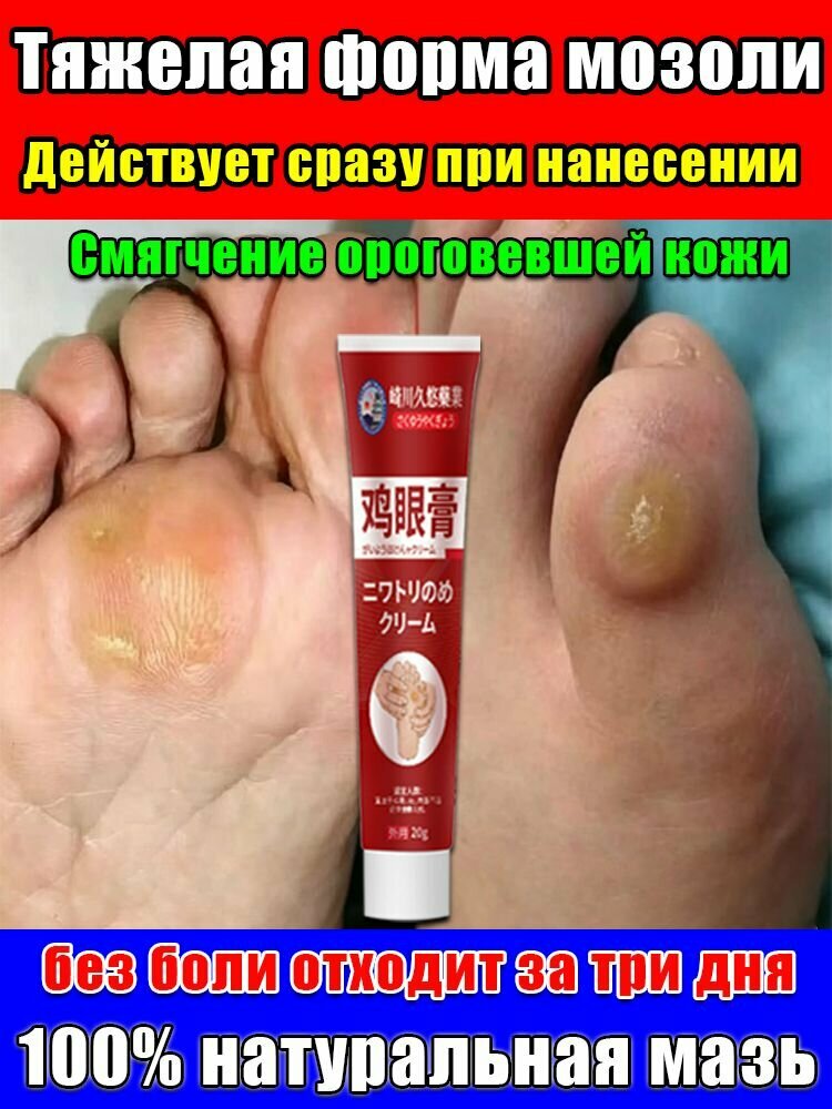 Мазь от стержневых мозолей на ногах смягчение и уход