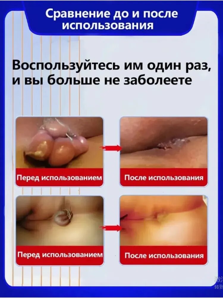 Релиф мазь от геморроя . Китайский чудо-крем 20 г. мускусный крем от геморроя