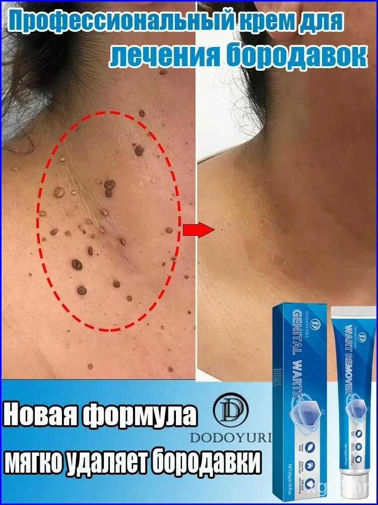 Эксклюзивный крем для безболезненного удаления бородавок, папиллом и родинок додоюри, не оставляющий следов и побочных эффектов, 20 г
