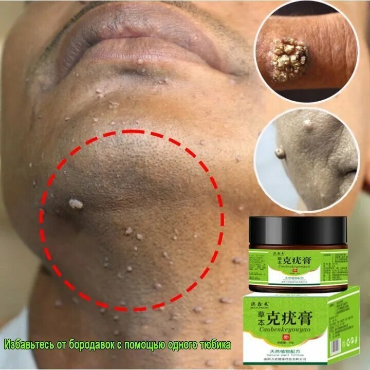 Средство от бородавок и папилом Мазь Быстро удалить бородавки со всех частей тела 20g