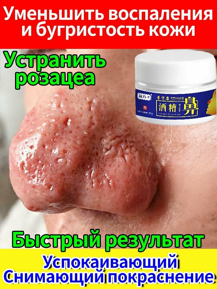 Крем от прыщей / От акне и постакне, для проблемной кожи лица, от шелушения, от покраснений, от псориаза, acnelyse от угрей / 30 мл