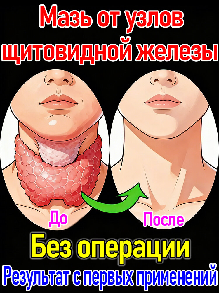Мазь для щитовидной железы, для людей, испытывающих дискомфорт и боль из-за увеличения щитовидной железы, узлов или увеличения лимфатических узлов