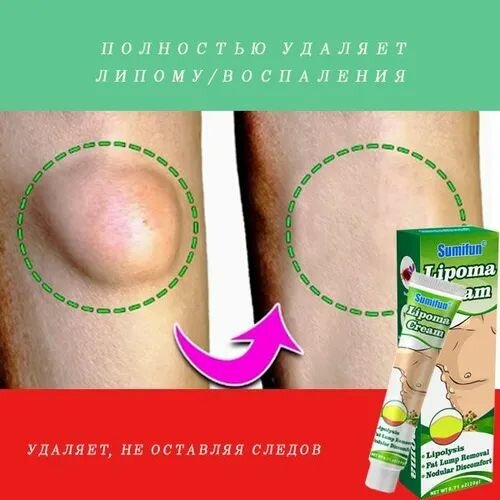 Липома удаляет крем, для устранения жировых отложений и подкожных шишек, показан при отечности кожи 20 г
