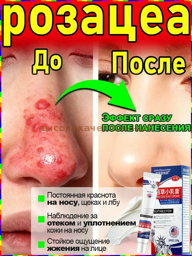 Крем для лица при куперозе, покраснениях, акне и розацеа укрепляет кожный барьер, снимает воспаление, зуд и раздражение, 20 г