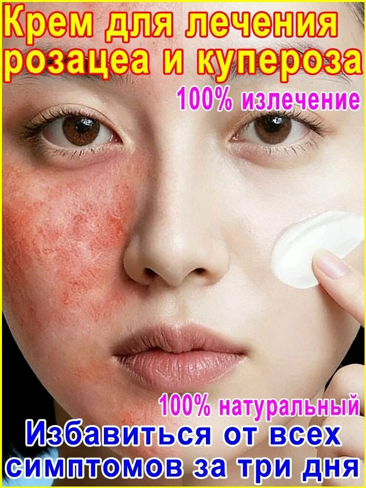 Крем для лица от купероза, розацеа, покраснений "Тонус-Капилляр Лица". для проблемной кожи,100% натуральный В безгормональном составе.20 мл проблемная кожа 100% натуральный без гормонов 20 мл