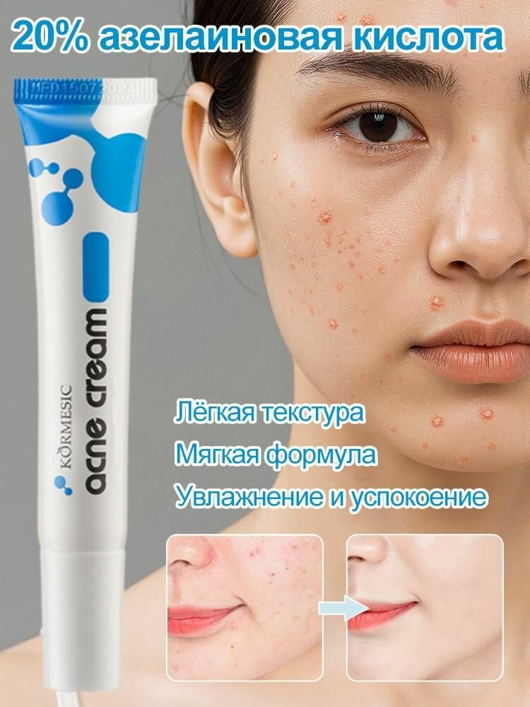 Крем от акне с 20% азелаиновой кислотой