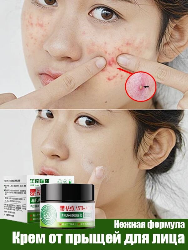 Крем против акне, подходит для лечения воспалений лица и угрей, жирной и чувствительной кожи, подходит для лица и тела