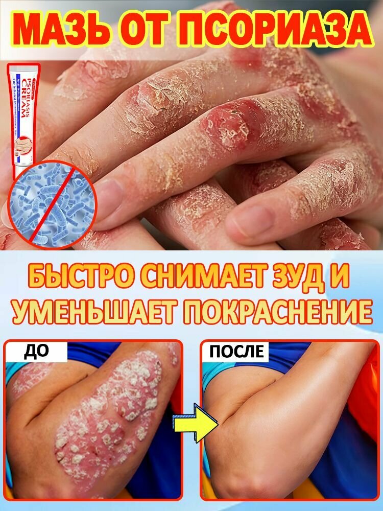 Крем от псориаза, который может облегчить зуд, раздражение и шелушение кожи, а также подавить грибковые и бактериальные инфекции, 100 грамм.
