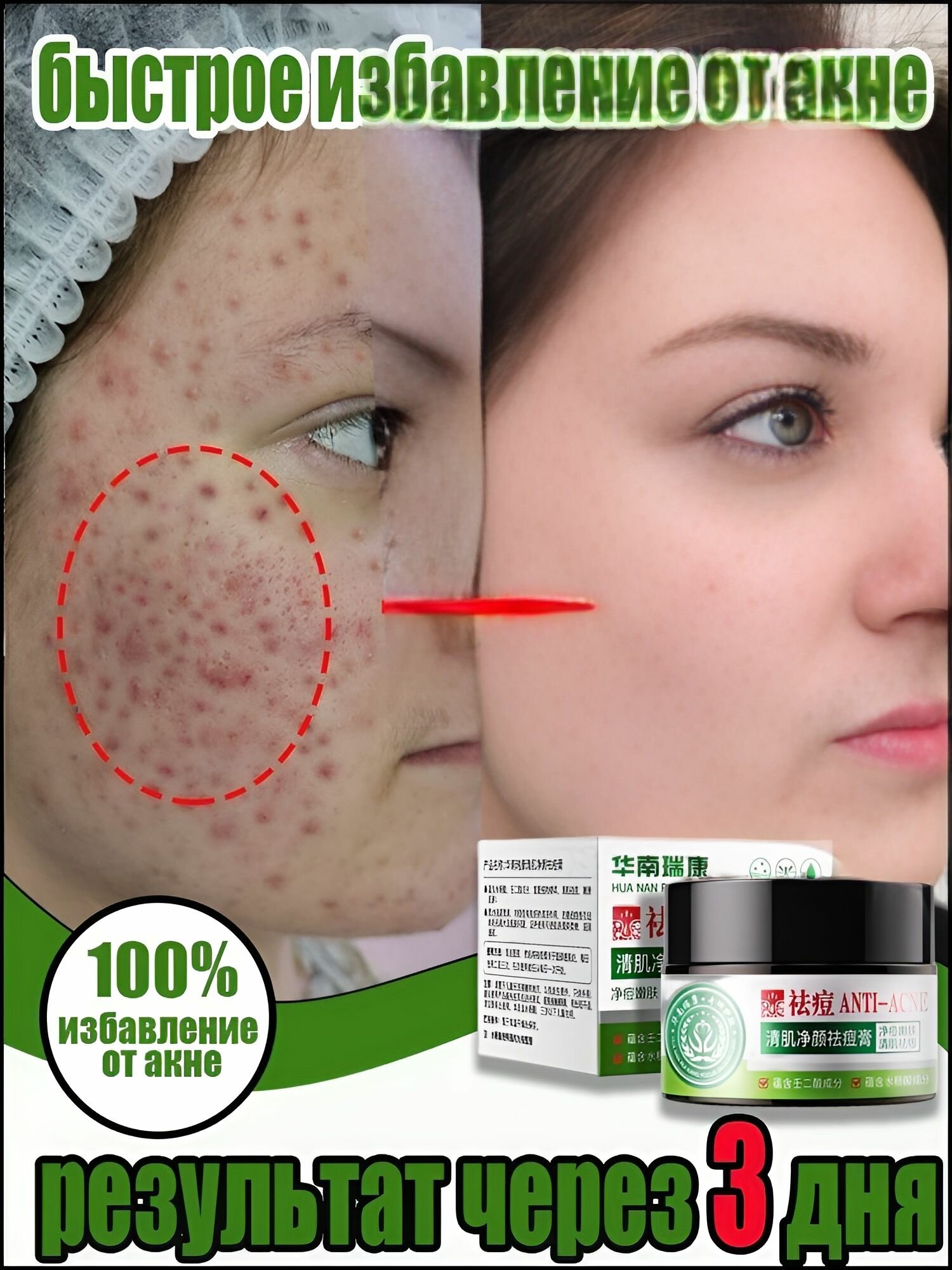 Крем против акне/против прыщей, для борьбы с угревой сыпью, комедонами и черными точками, подходит для подростков, для проблемной кожи, 30 г